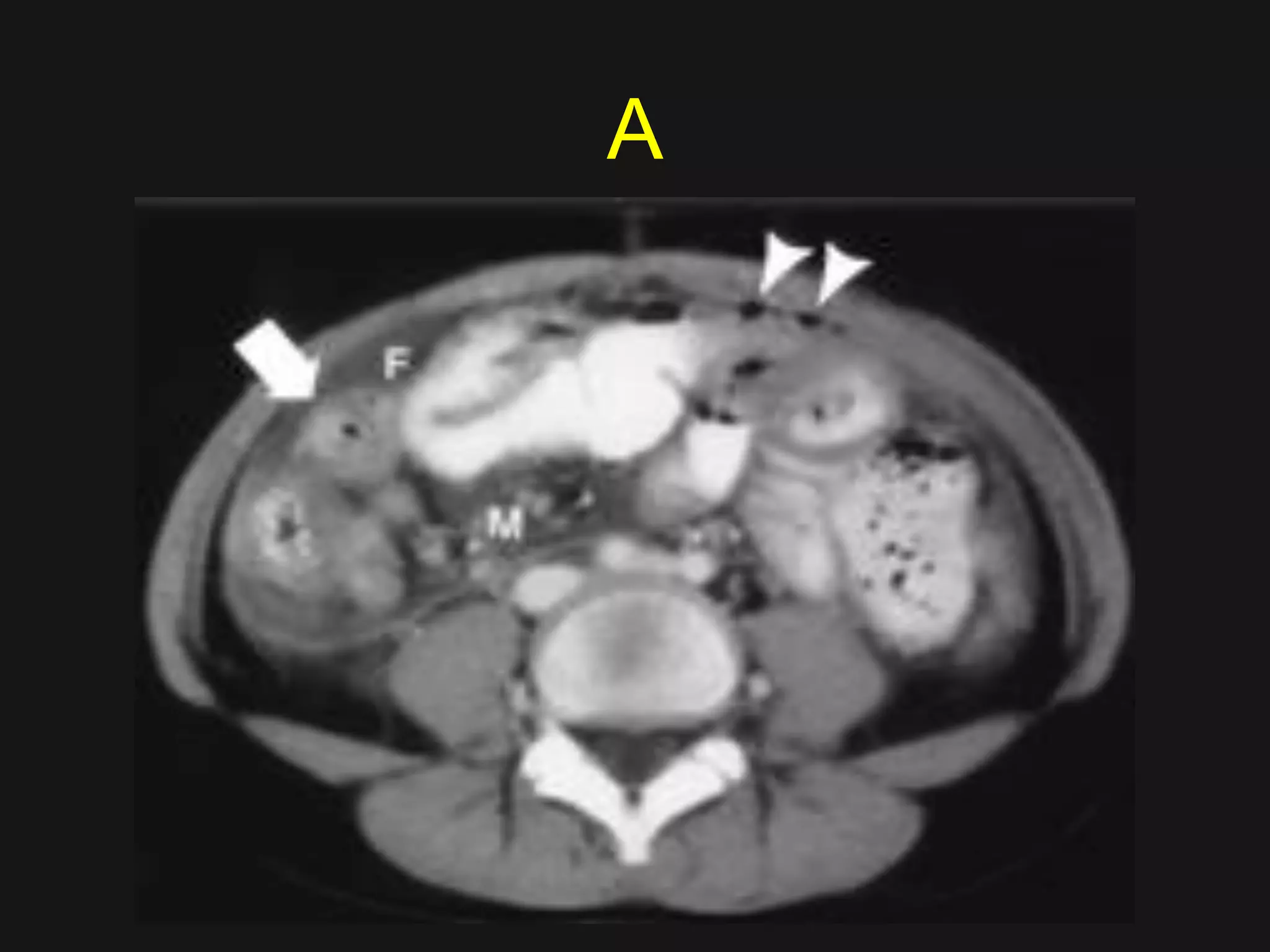 Imaging abdomen trauma mesenteric bowel trauma part 6 Dr Ahmed Esawy | PPT