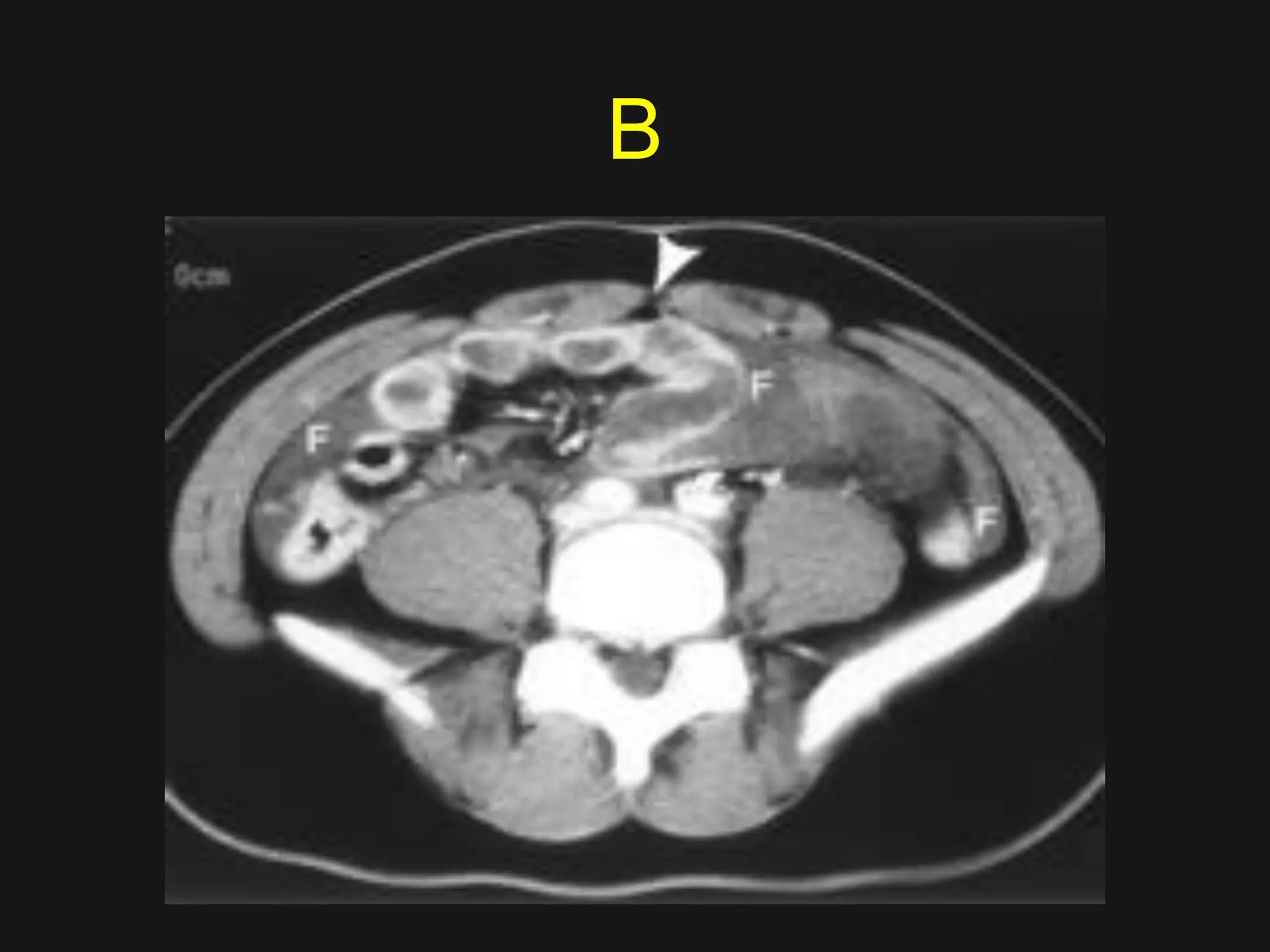 Imaging abdomen trauma mesenteric bowel trauma part 6 Dr Ahmed Esawy | PPT