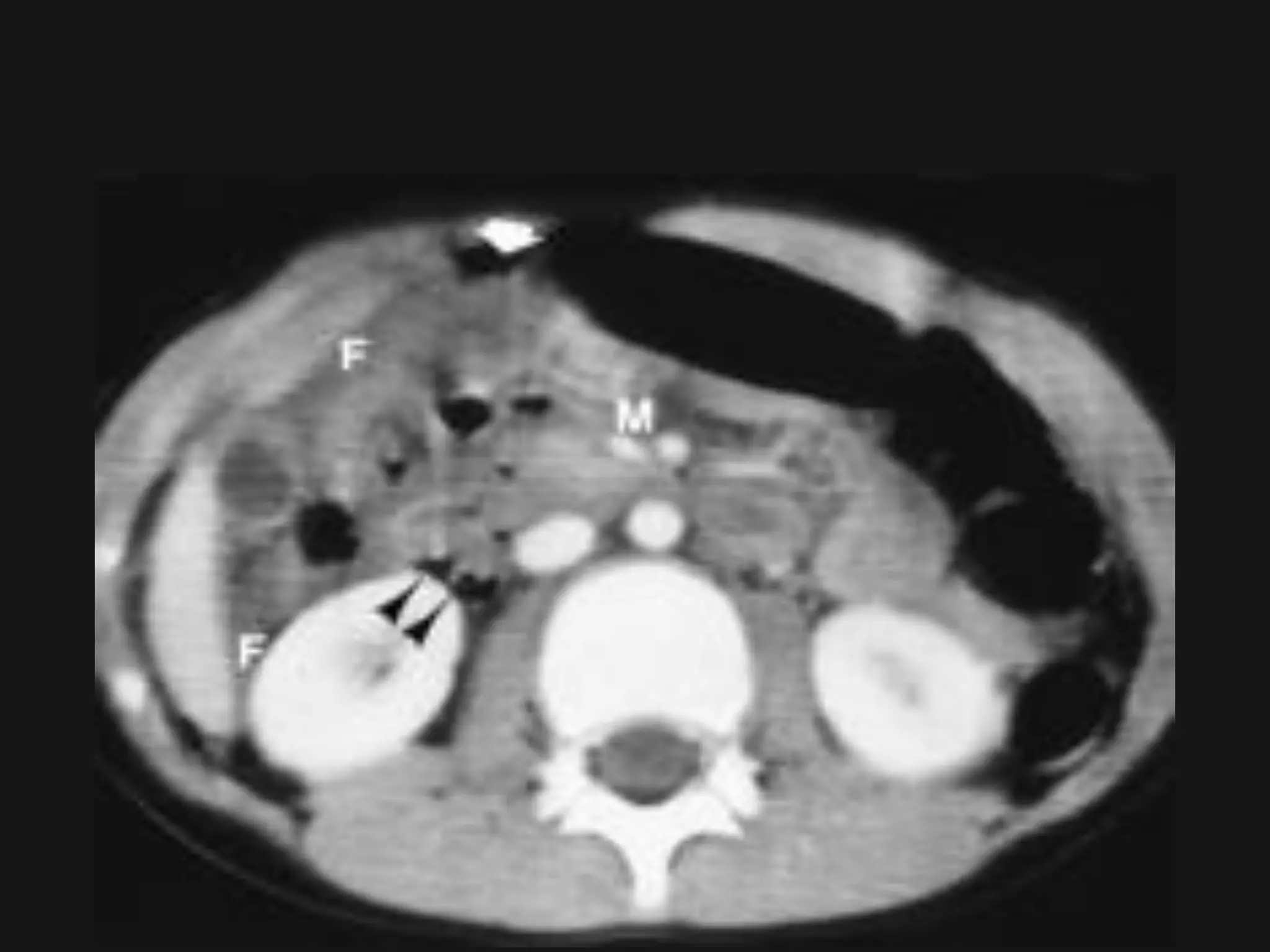 Imaging abdomen trauma mesenteric bowel trauma part 6 Dr Ahmed Esawy | PPT