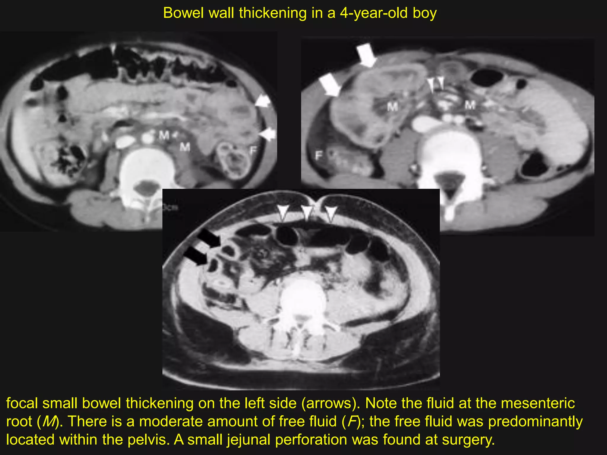 Imaging abdomen trauma mesenteric bowel trauma part 6 Dr Ahmed Esawy | PPT
