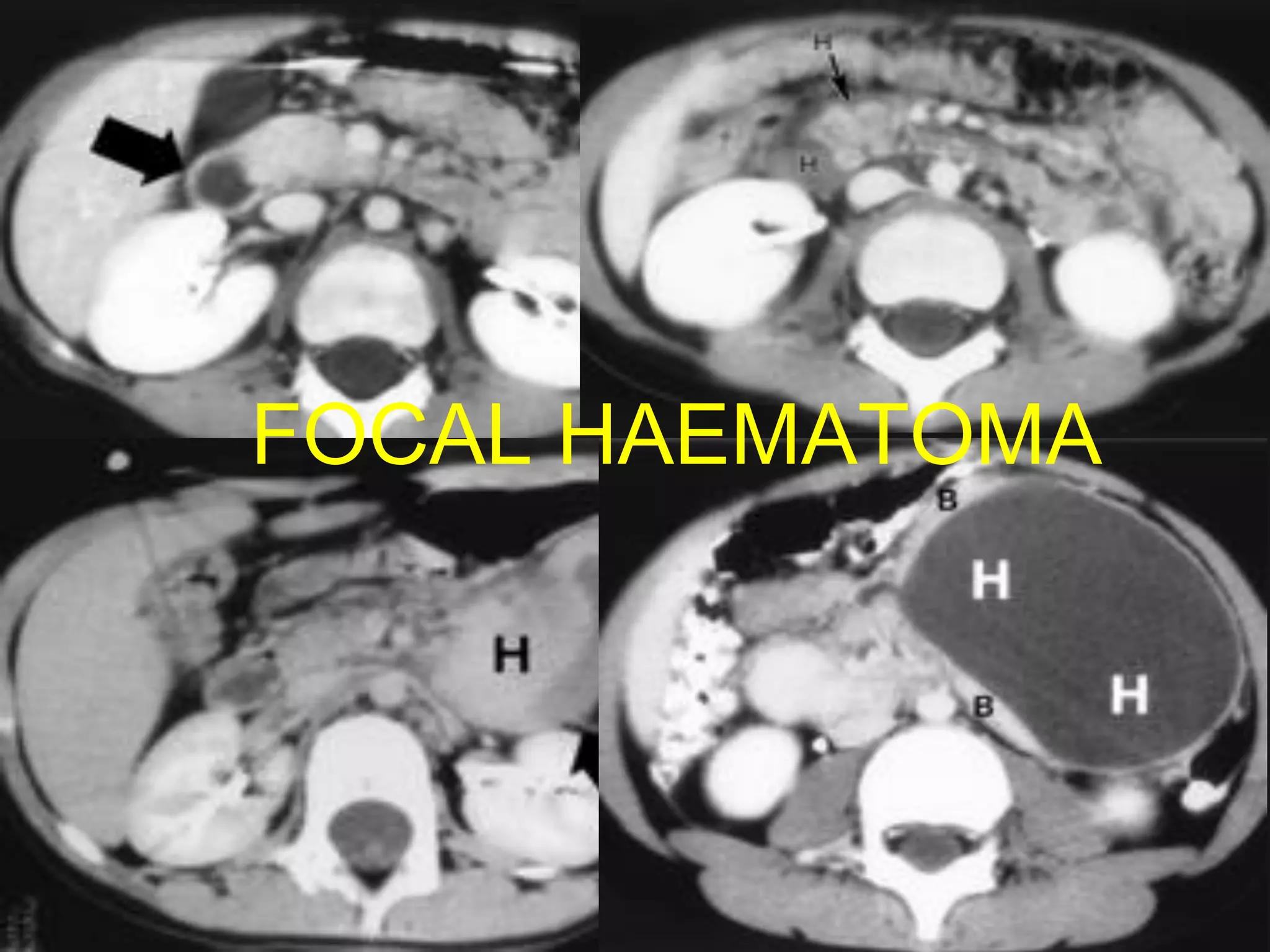 Imaging abdomen trauma mesenteric bowel trauma part 6 Dr Ahmed Esawy | PPT