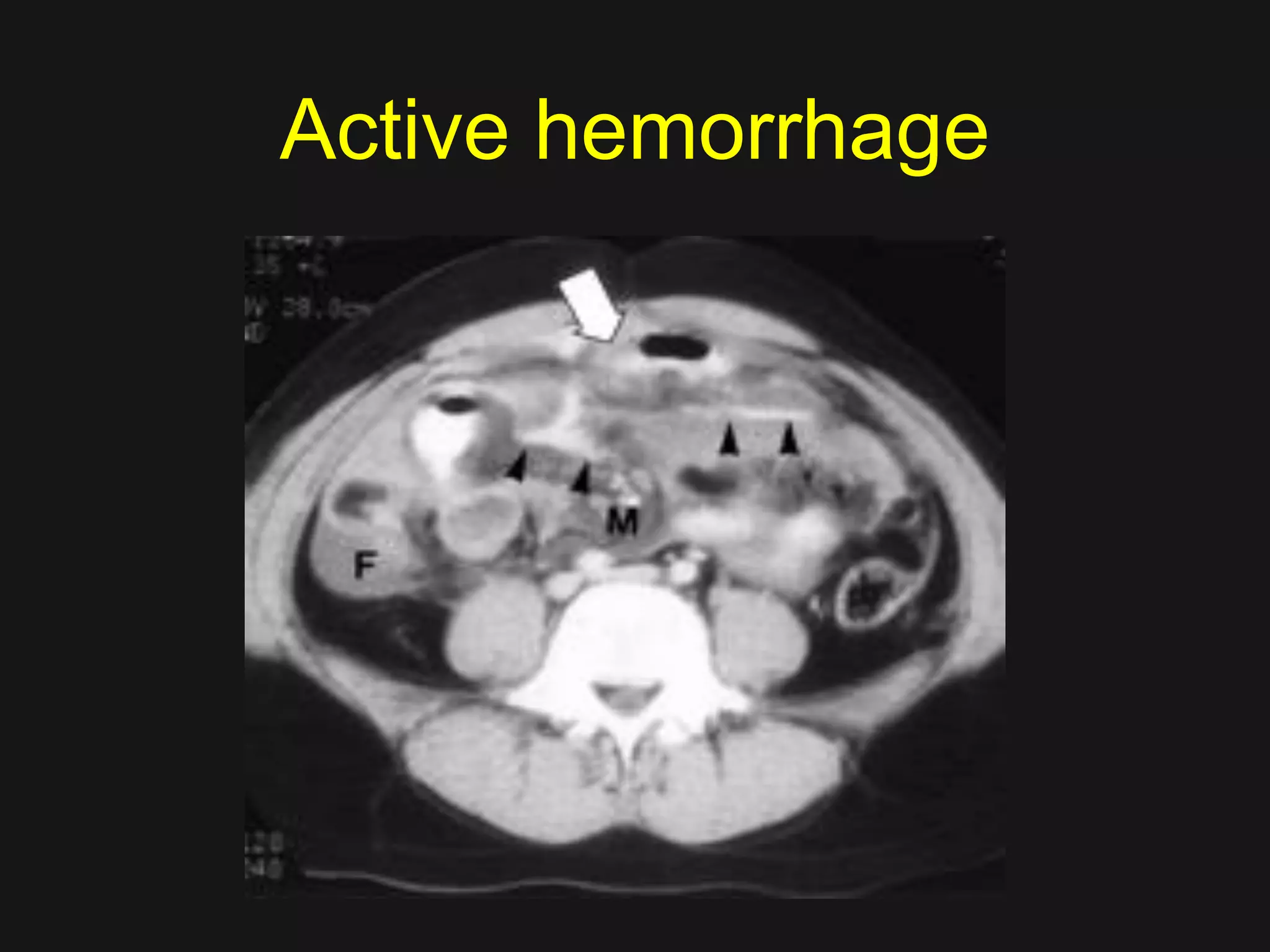 Imaging abdomen trauma mesenteric bowel trauma part 6 Dr Ahmed Esawy | PPT