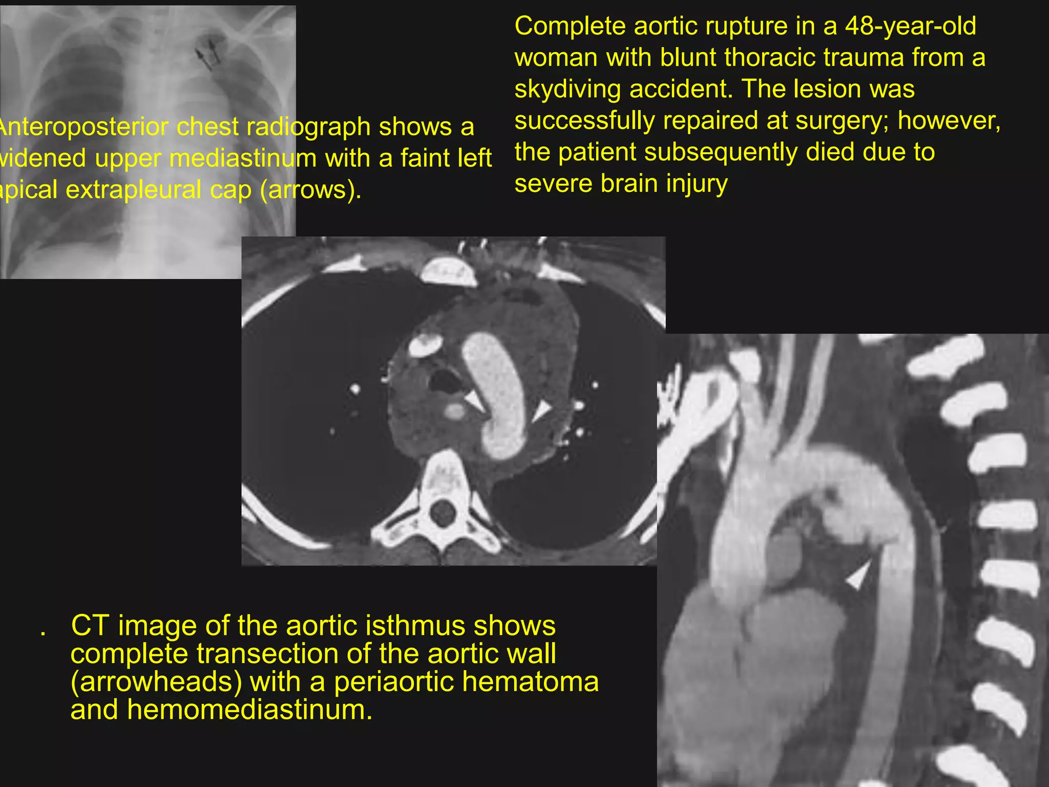 Imaging abdomen trauma mesenteric bowel trauma part 6 Dr Ahmed Esawy | PPT