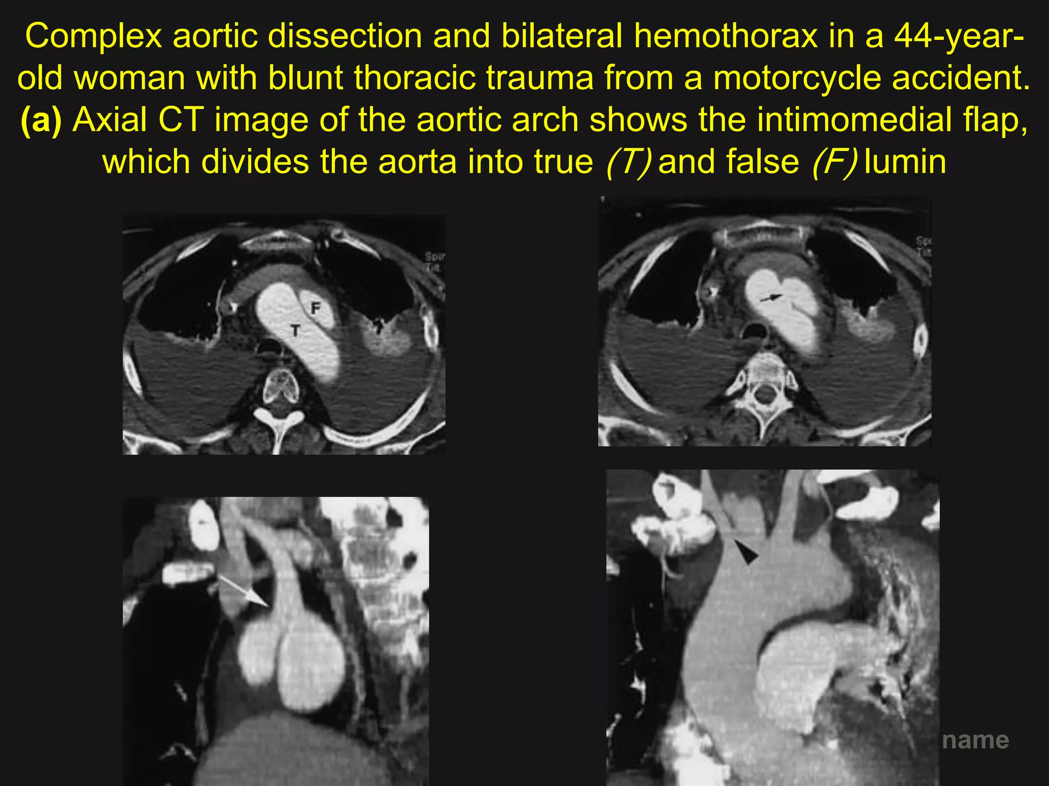 Imaging abdomen trauma mesenteric bowel trauma part 6 Dr Ahmed Esawy | PPT