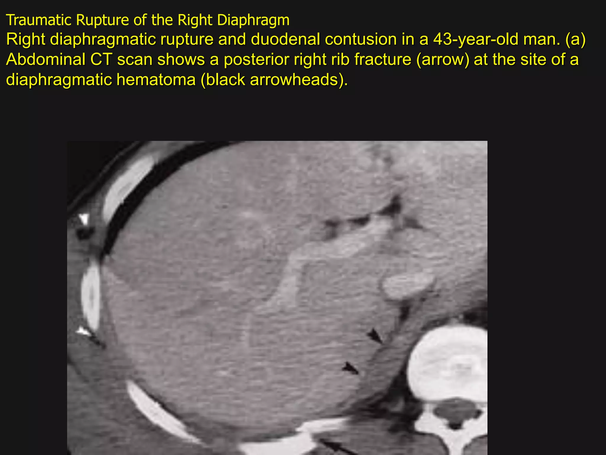 Imaging abdomen trauma mesenteric bowel trauma part 6 Dr Ahmed Esawy | PPT