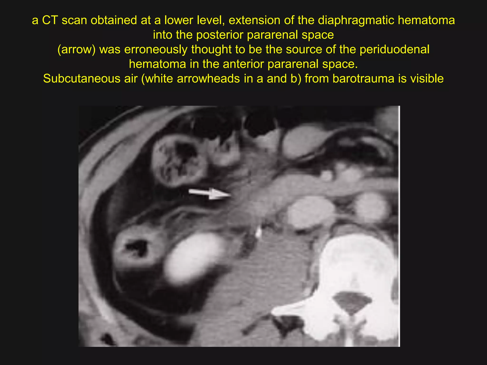 Imaging abdomen trauma mesenteric bowel trauma part 6 Dr Ahmed Esawy | PPT