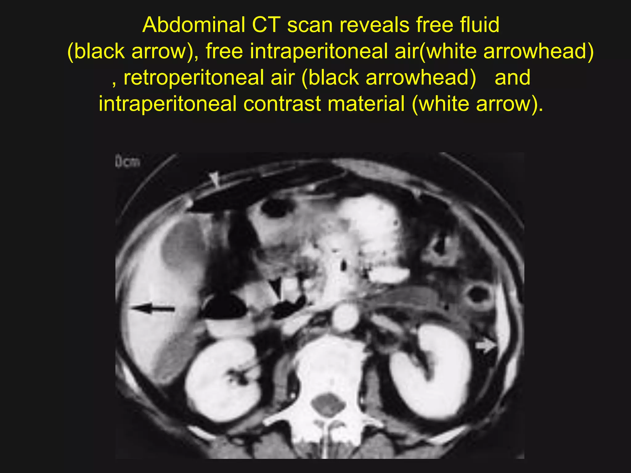 Imaging abdomen trauma mesenteric bowel trauma part 6 Dr Ahmed Esawy | PPT