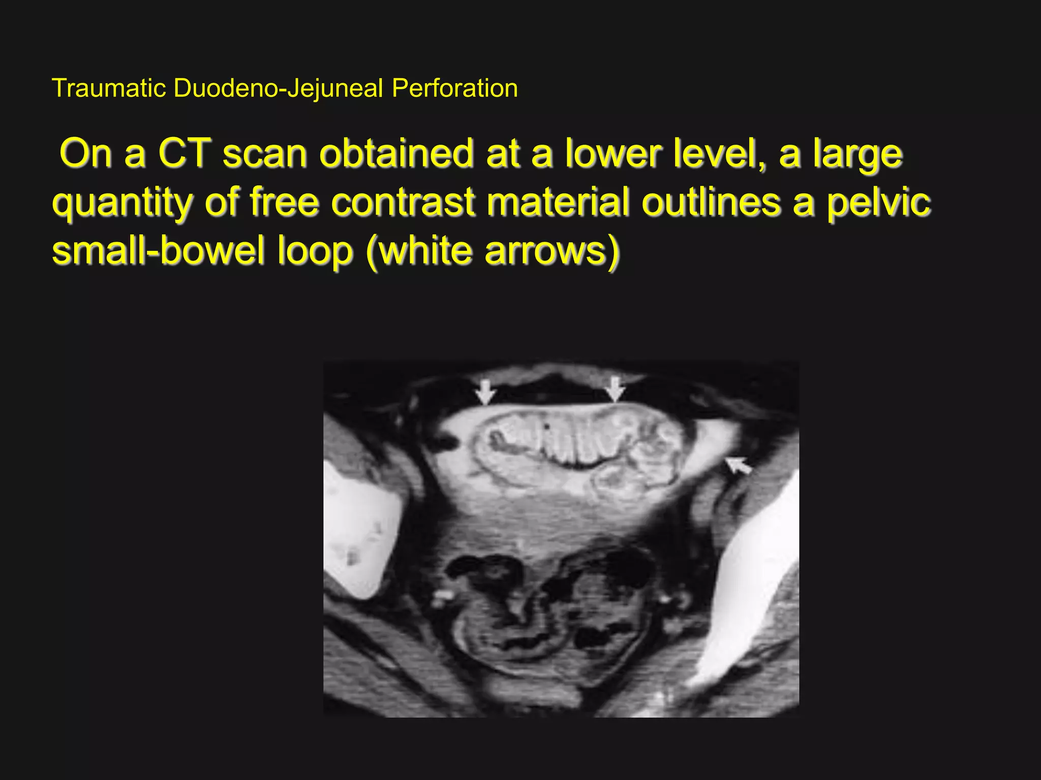 Imaging abdomen trauma mesenteric bowel trauma part 6 Dr Ahmed Esawy | PPT