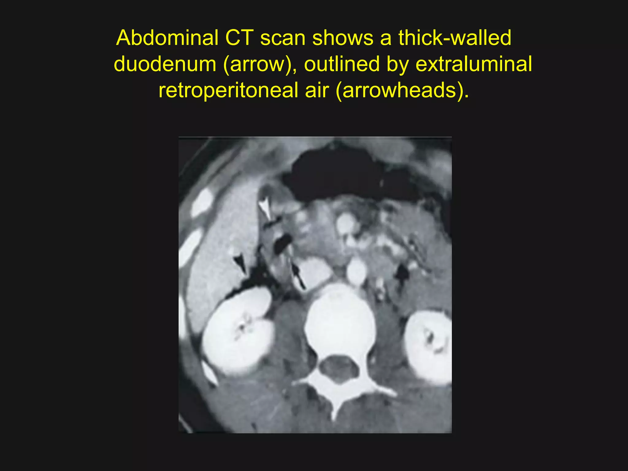 Imaging abdomen trauma mesenteric bowel trauma part 6 Dr Ahmed Esawy | PPT