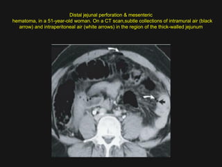 Imaging abdomen trauma mesenteric bowel trauma part 6 Dr Ahmed Esawy | PDF