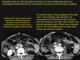 Imaging abdomen trauma mesenteric bowel trauma part 6 Dr Ahmed Esawy | PDF