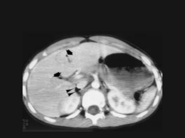 Imaging abdomen trauma mesenteric bowel trauma part 6 Dr Ahmed Esawy | PPT