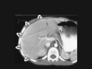 Imaging abdomen trauma mesenteric bowel trauma part 6 Dr Ahmed Esawy | PDF