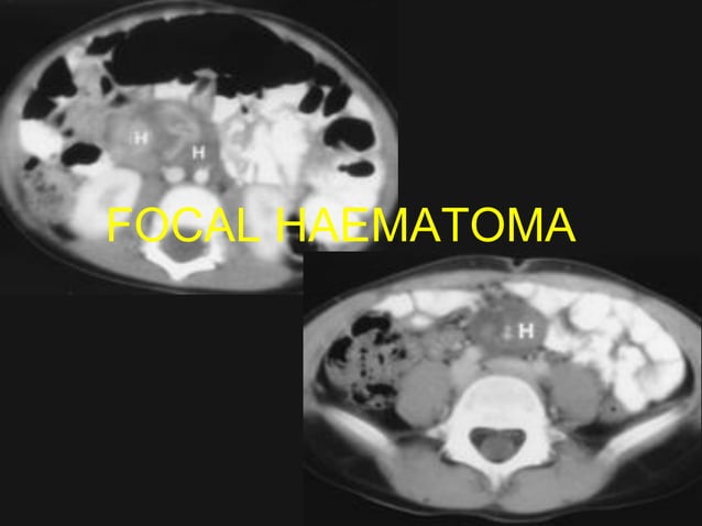 Imaging abdomen trauma mesenteric bowel trauma part 6 Dr Ahmed Esawy | PPT