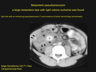 Imaging abdomen trauma mesenteric bowel trauma part 6 Dr Ahmed Esawy | PDF