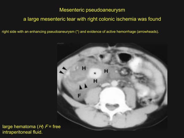 Imaging abdomen trauma mesenteric bowel trauma part 6 Dr Ahmed Esawy | PPT