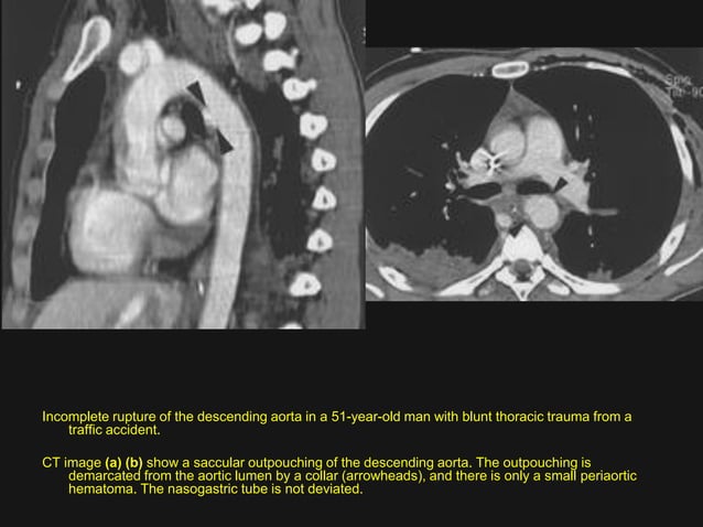 Imaging abdomen trauma mesenteric bowel trauma part 6 Dr Ahmed Esawy | PPT