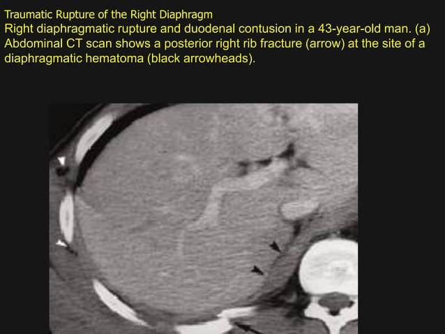 Imaging abdomen trauma mesenteric bowel trauma part 6 Dr Ahmed Esawy | PPT