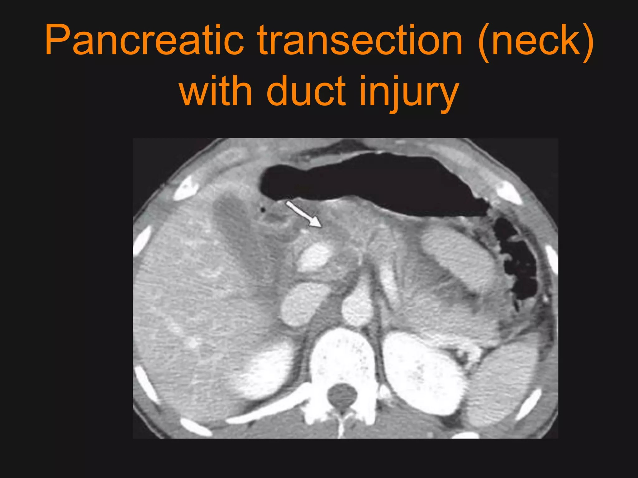 Imaging abdomen trauma pancreatic trauma part 4 Dr Ahmed Esawy | PDF