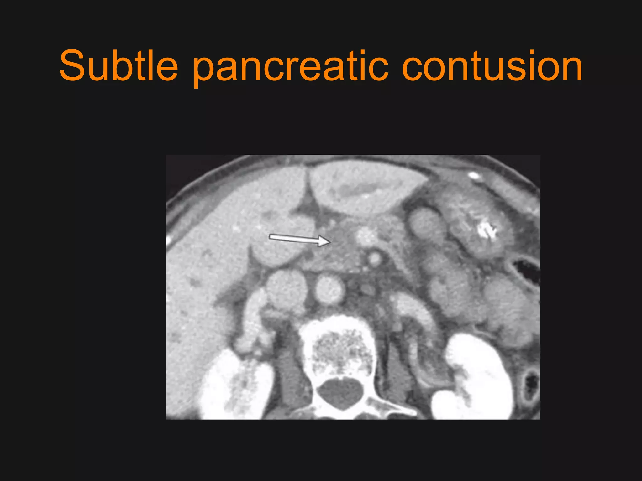 Imaging abdomen trauma pancreatic trauma part 4 Dr Ahmed Esawy | PDF