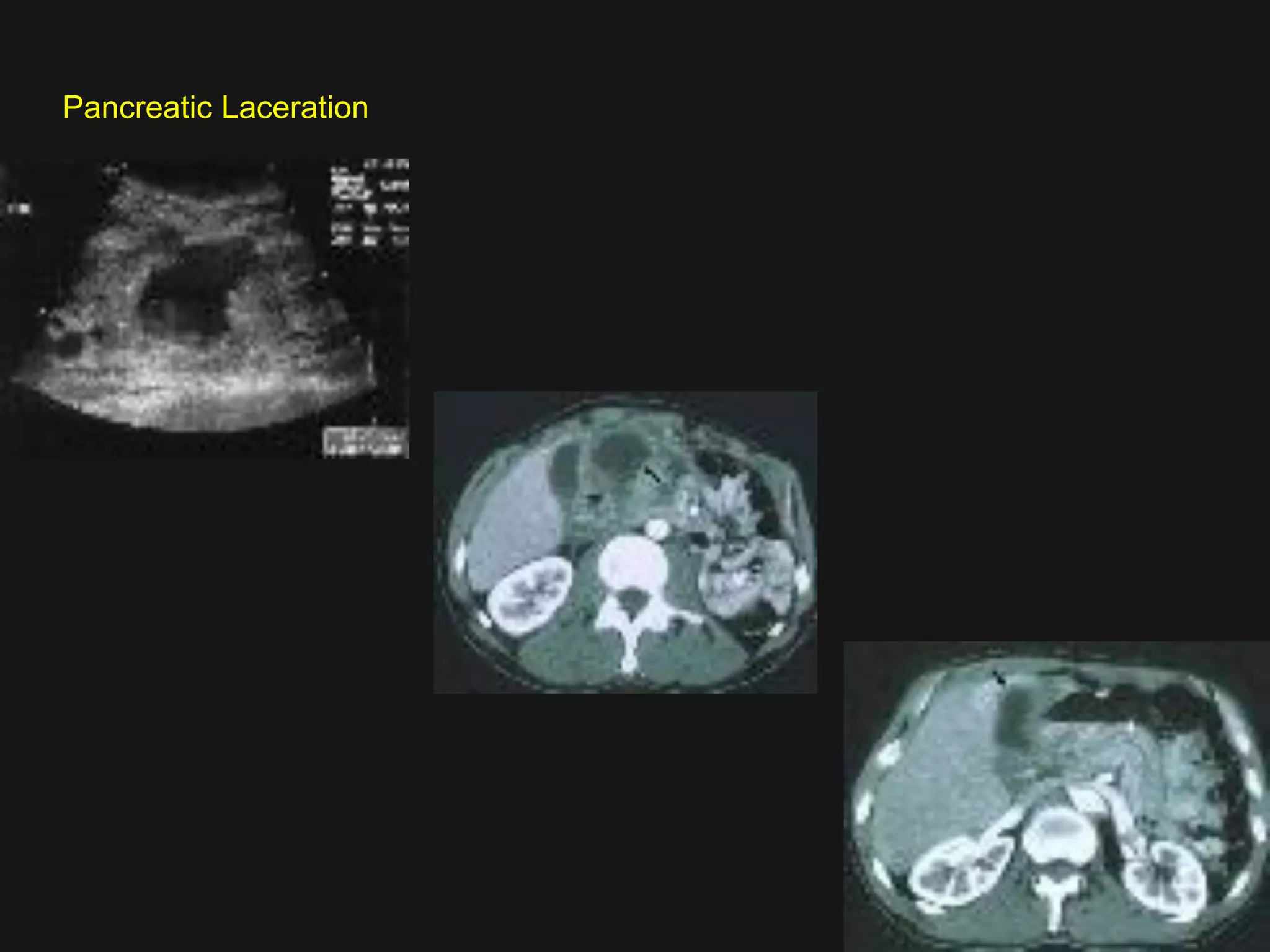 Imaging abdomen trauma pancreatic trauma part 4 Dr Ahmed Esawy | PDF