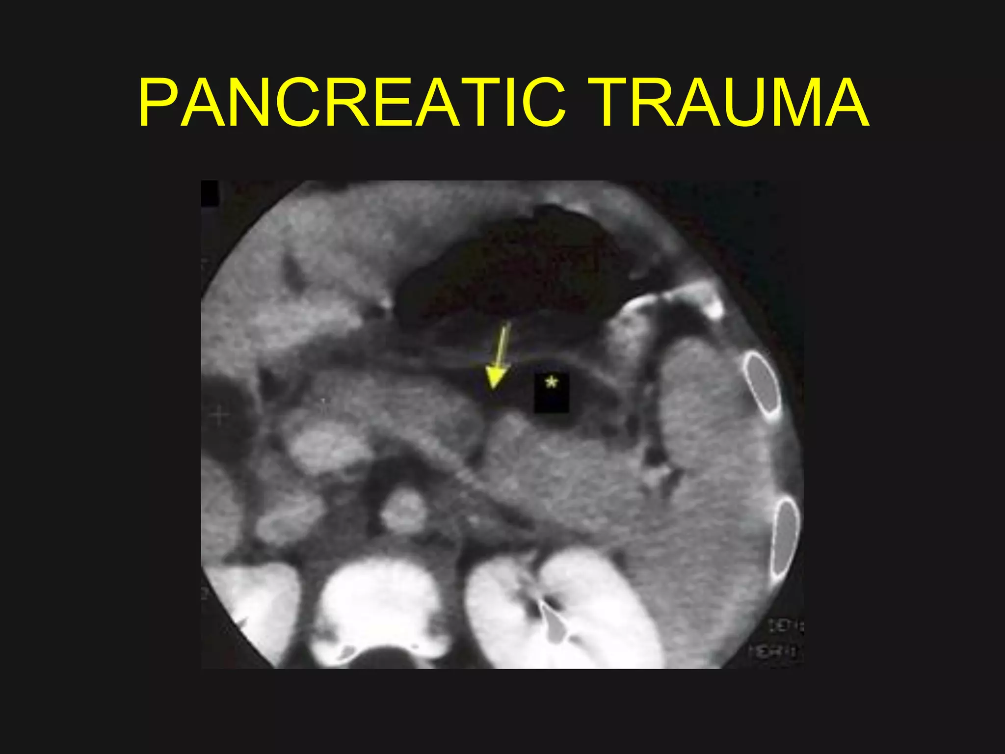 Imaging abdomen trauma pancreatic trauma part 4 Dr Ahmed Esawy | PDF