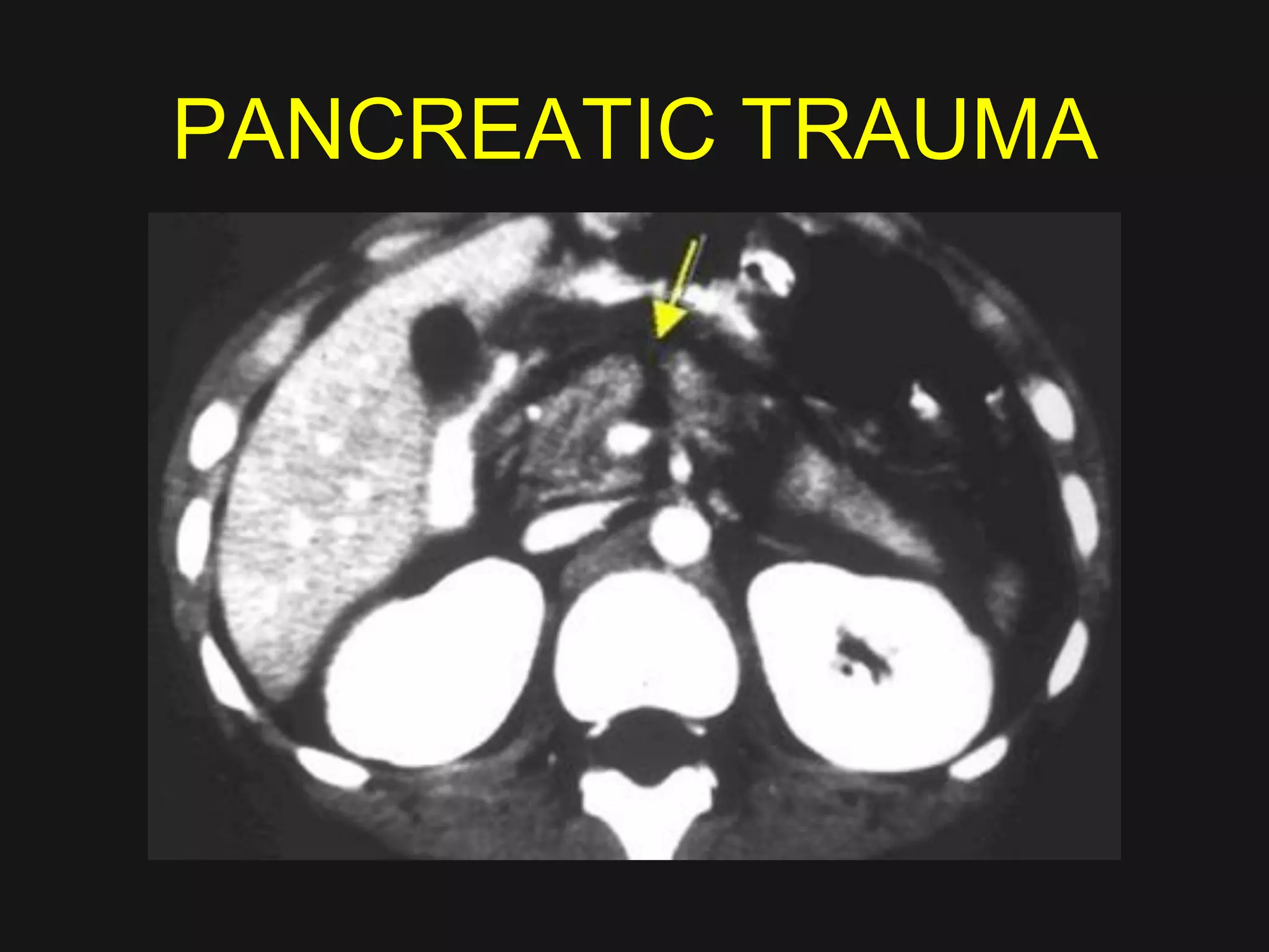 Imaging abdomen trauma pancreatic trauma part 4 Dr Ahmed Esawy | PDF