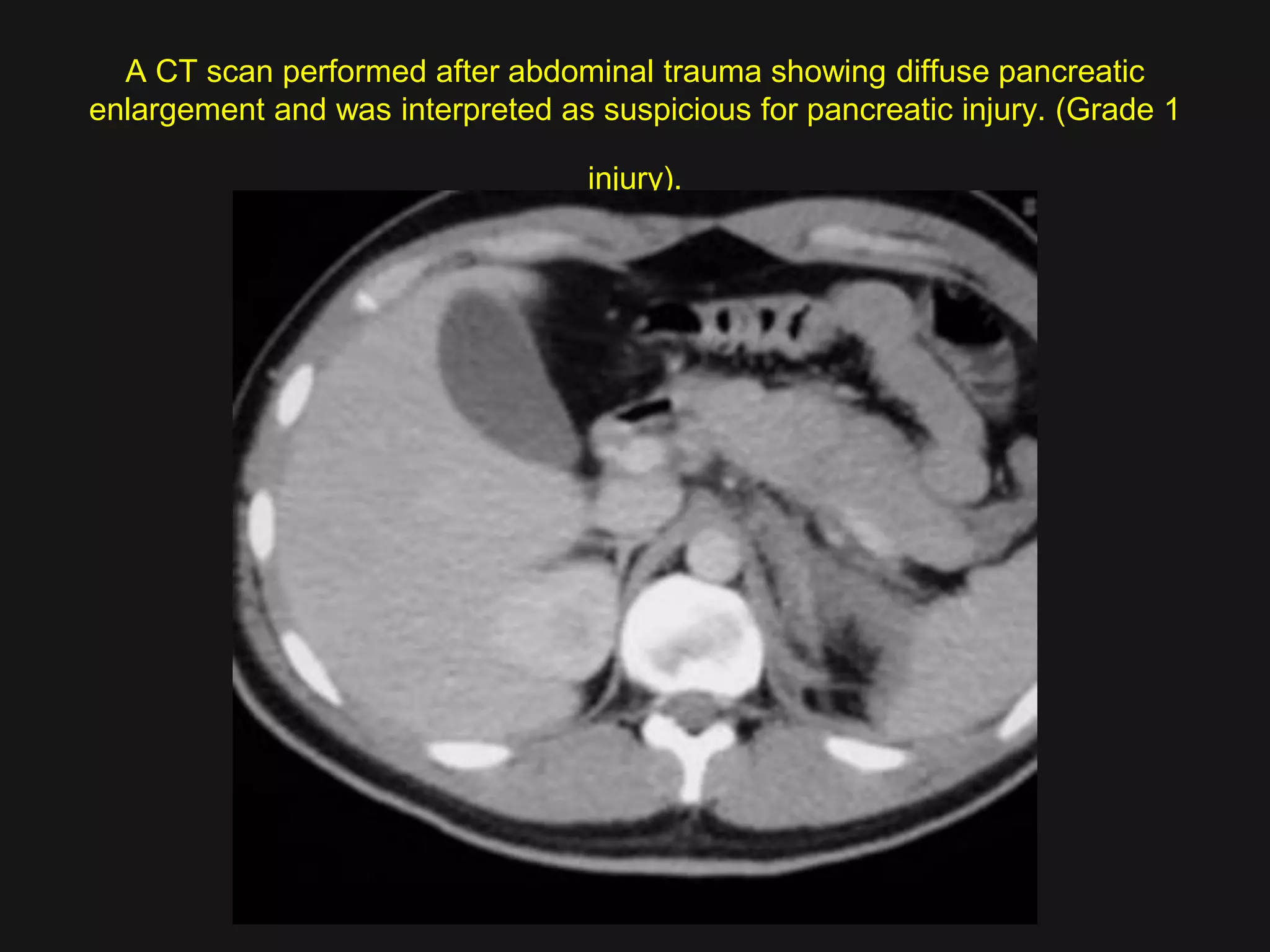 Imaging abdomen trauma pancreatic trauma part 4 Dr Ahmed Esawy | PDF