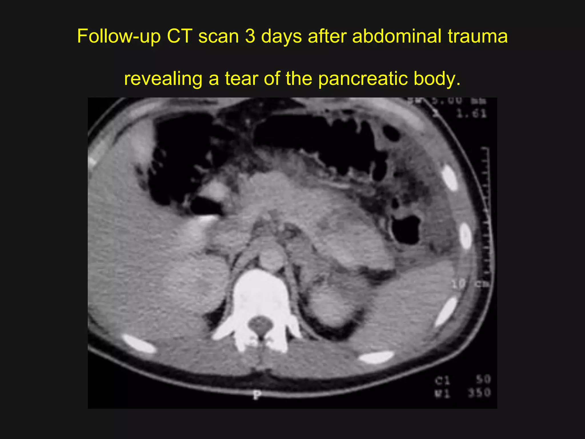 Imaging abdomen trauma pancreatic trauma part 4 Dr Ahmed Esawy | PDF
