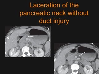 Imaging abdomen trauma pancreatic trauma part 4 Dr Ahmed Esawy | PDF