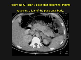 Imaging abdomen trauma pancreatic trauma part 4 Dr Ahmed Esawy | PDF