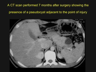 Imaging abdomen trauma pancreatic trauma part 4 Dr Ahmed Esawy | PDF