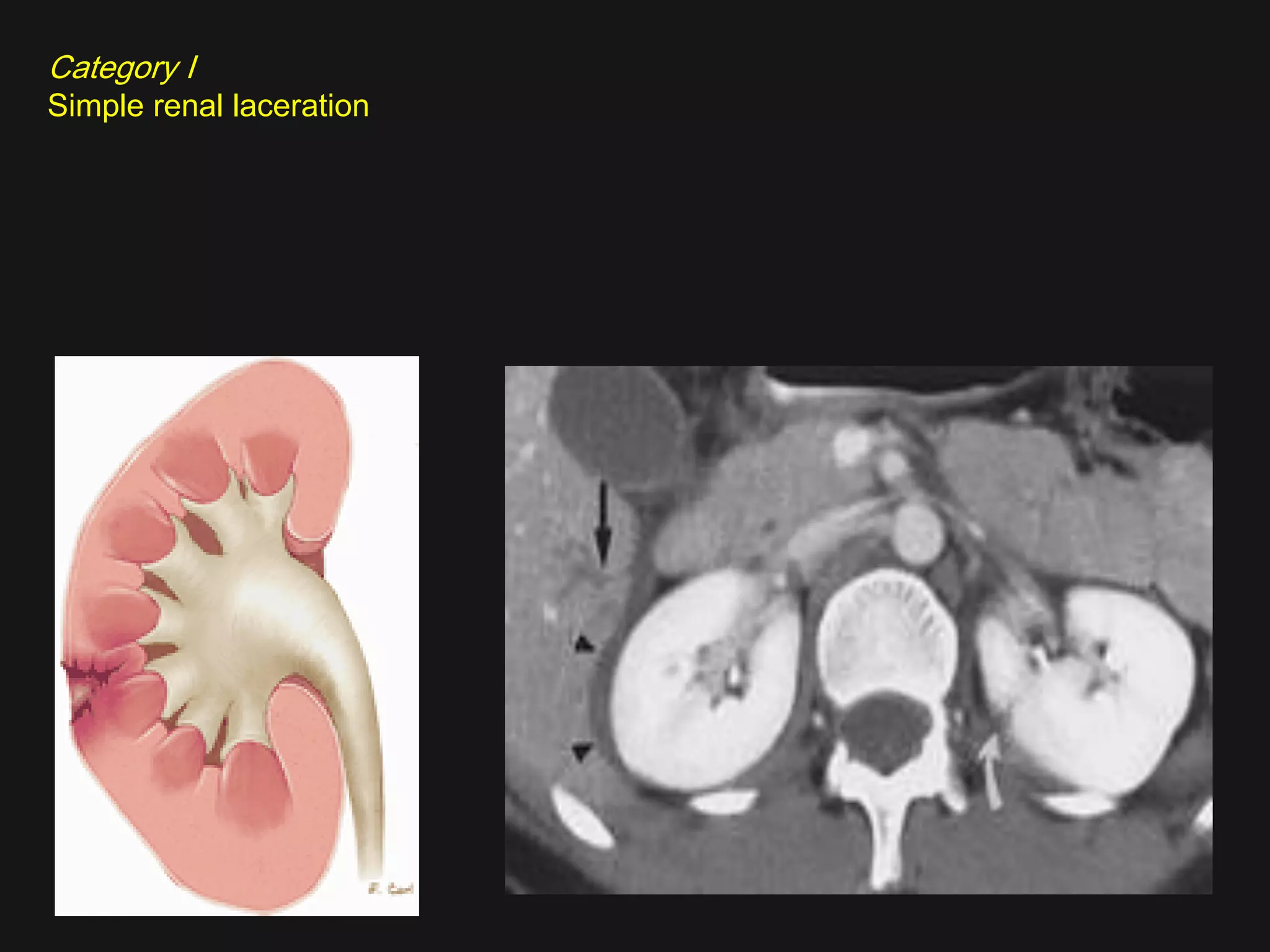 Imaging abdomen trauma renal part 5 Dr Ahmed Esawy | PPT