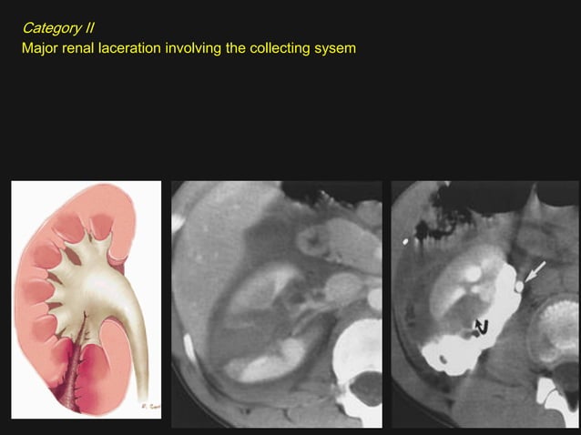 Imaging abdomen trauma renal part 5 Dr Ahmed Esawy | PPT