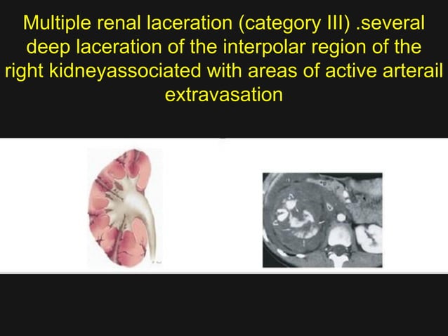 Imaging abdomen trauma renal part 5 Dr Ahmed Esawy | PPT