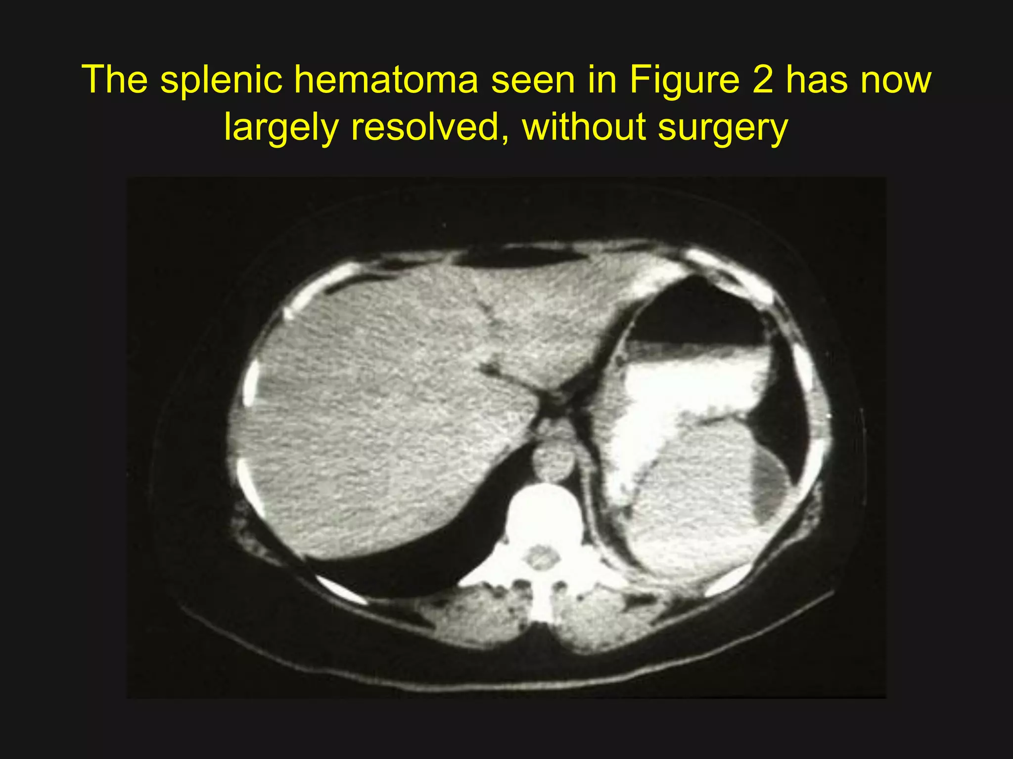 Imaging abdomen trauma spleenic trauma part 3 Dr Ahmed Esawy | PDF