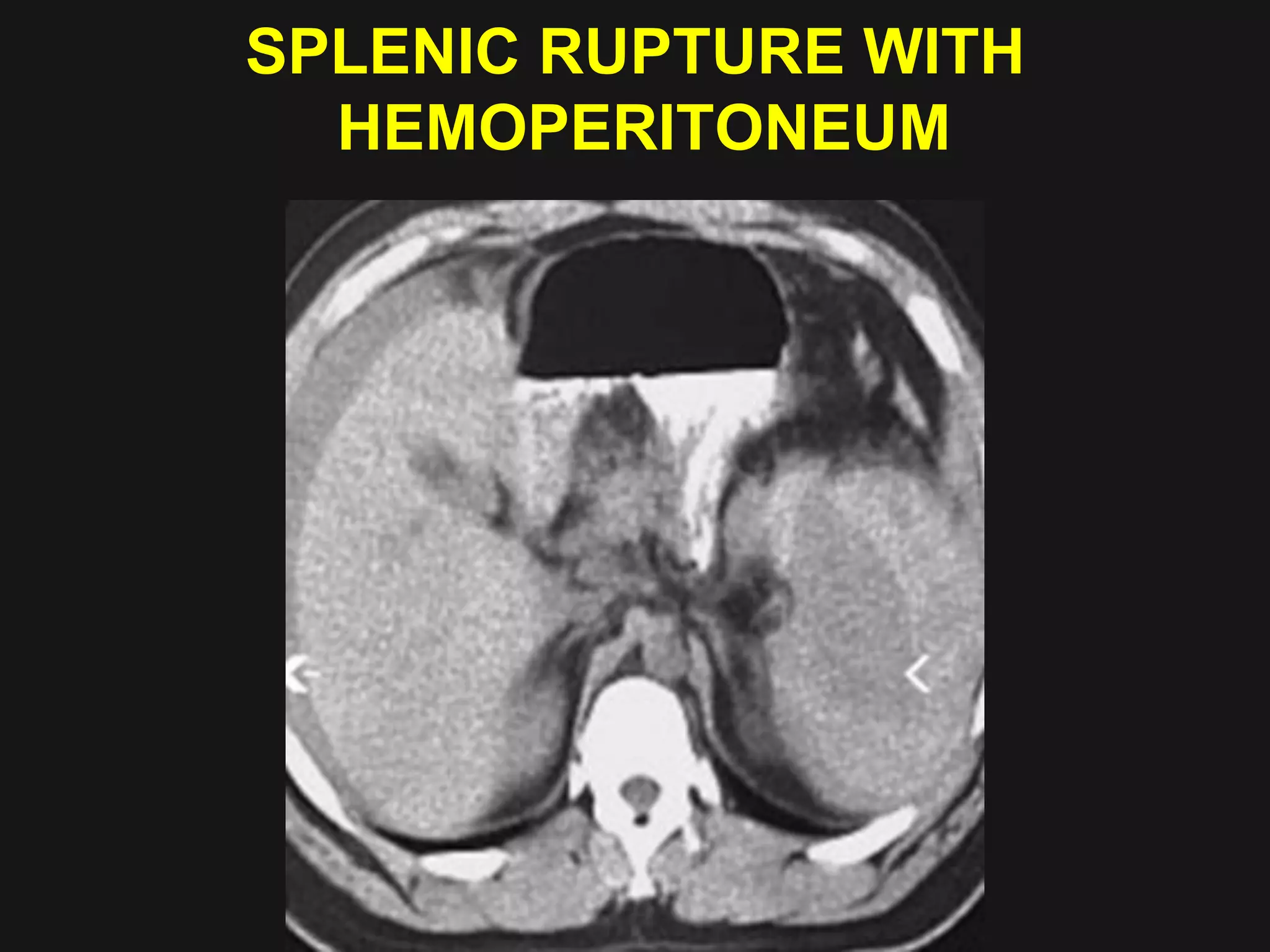 Imaging abdomen trauma spleenic trauma part 3 Dr Ahmed Esawy | PDF