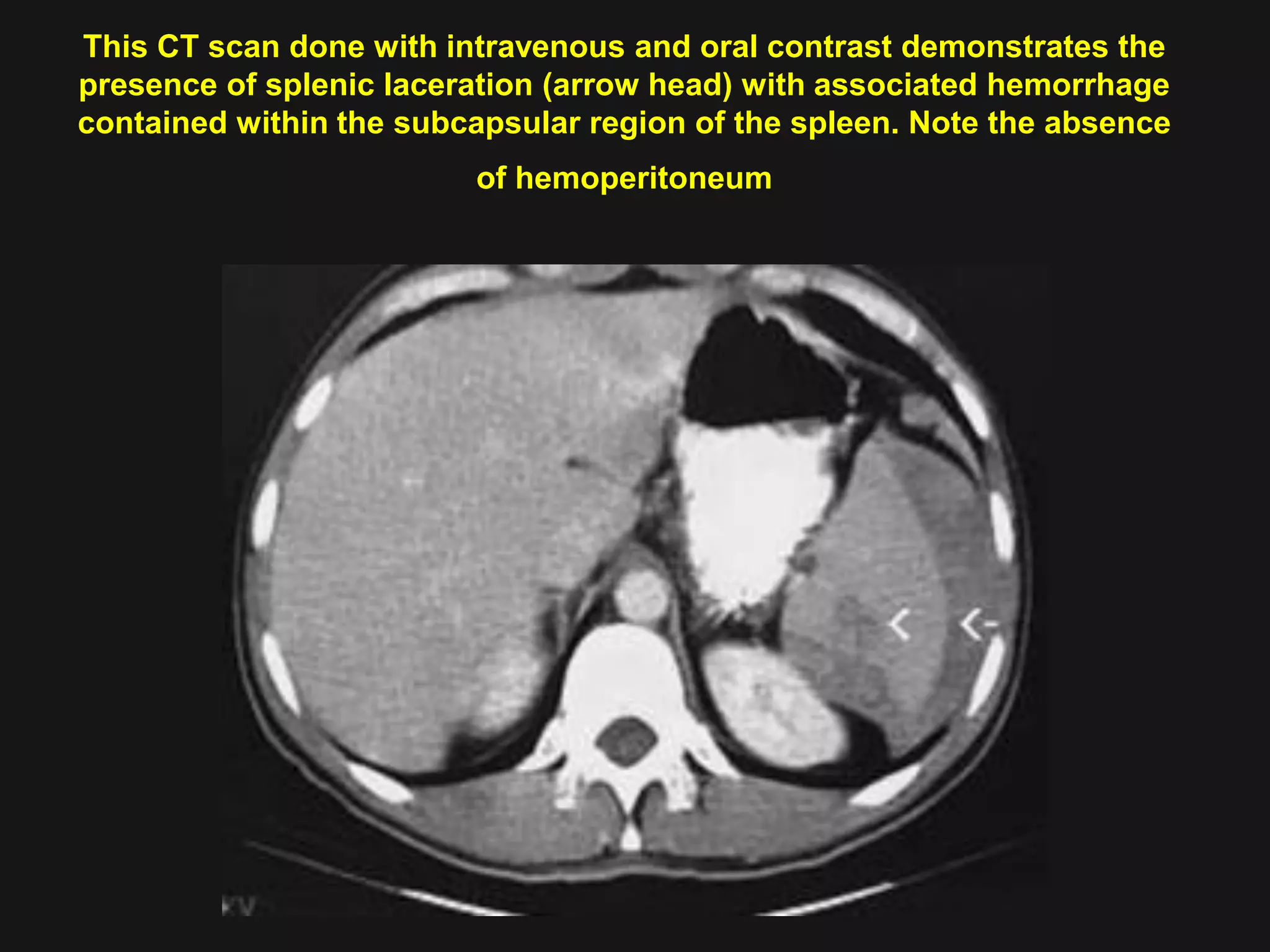 Imaging abdomen trauma spleenic trauma part 3 Dr Ahmed Esawy | PDF