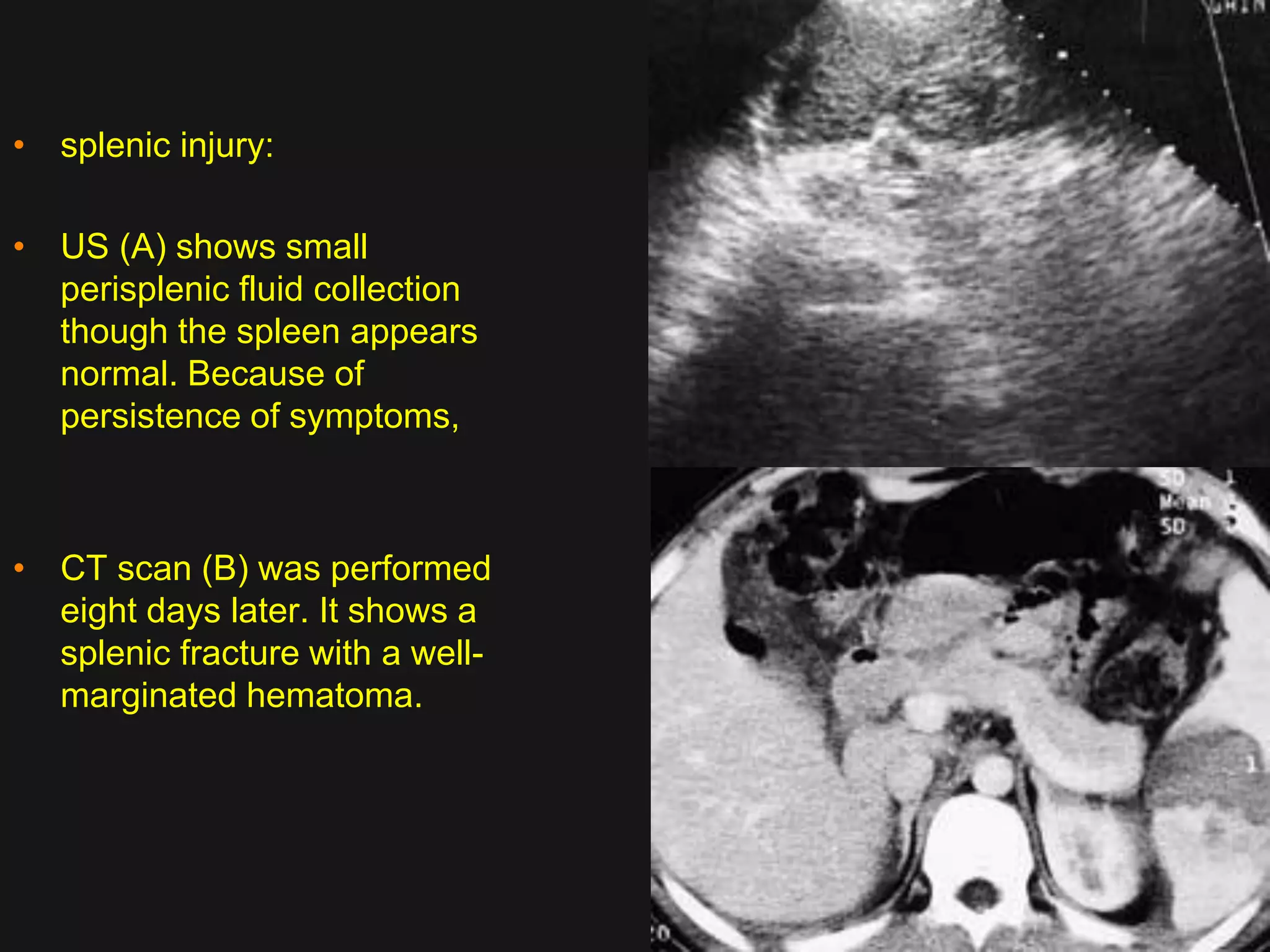 Imaging abdomen trauma spleenic trauma part 3 Dr Ahmed Esawy | PDF