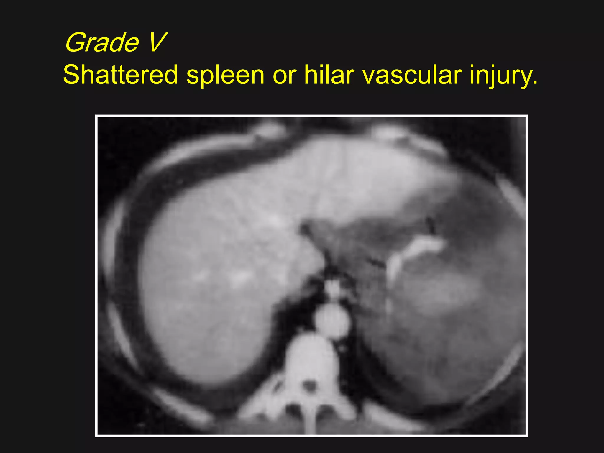 Imaging abdomen trauma spleenic trauma part 3 Dr Ahmed Esawy | PDF