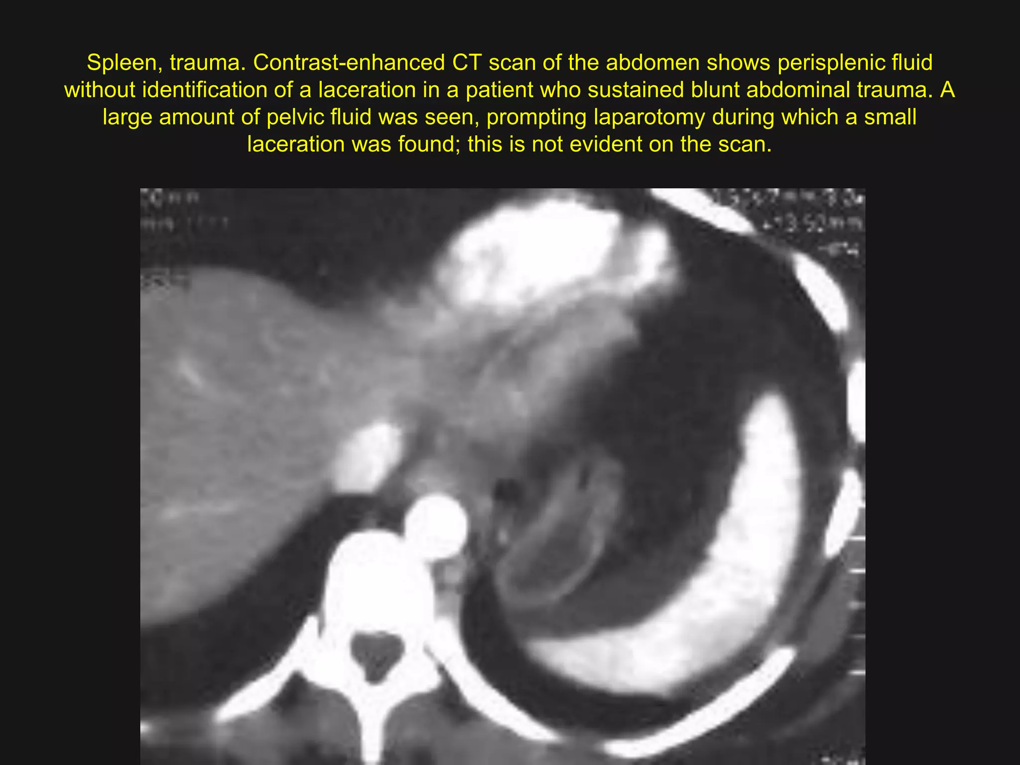 Imaging abdomen trauma spleenic trauma part 3 Dr Ahmed Esawy | PDF