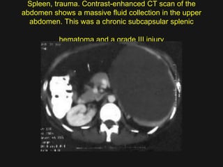 Imaging abdomen trauma spleenic trauma part 3 Dr Ahmed Esawy | PDF