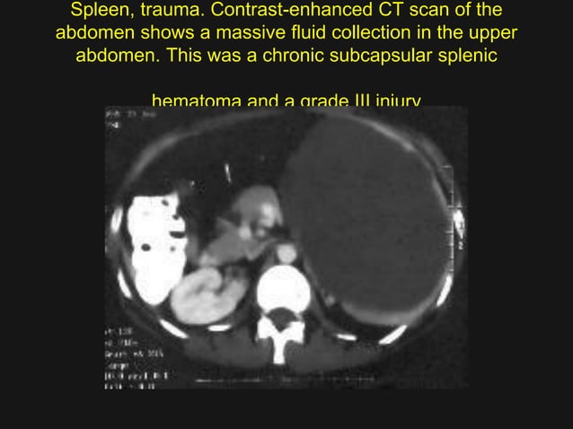 Imaging abdomen trauma spleenic trauma part 3 Dr Ahmed Esawy | PDF ...