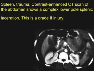 Imaging abdomen trauma spleenic trauma part 3 Dr Ahmed Esawy | PDF