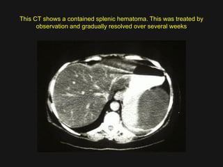 Imaging abdomen trauma spleenic trauma part 3 Dr Ahmed Esawy | PDF