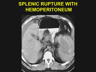 Imaging abdomen trauma spleenic trauma part 3 Dr Ahmed Esawy | PDF