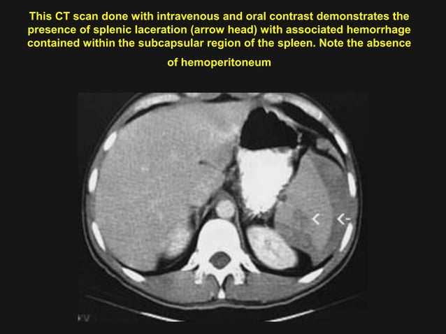 Imaging abdomen trauma spleenic trauma part 3 Dr Ahmed Esawy | PDF ...