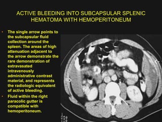 Imaging abdomen trauma spleenic trauma part 3 Dr Ahmed Esawy | PDF