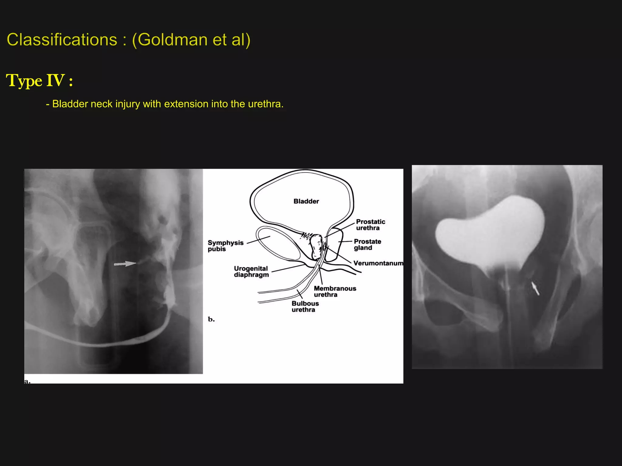 Imaging abdomen trauma urethra trauma part 9 Dr Ahmed Esawy | PPT