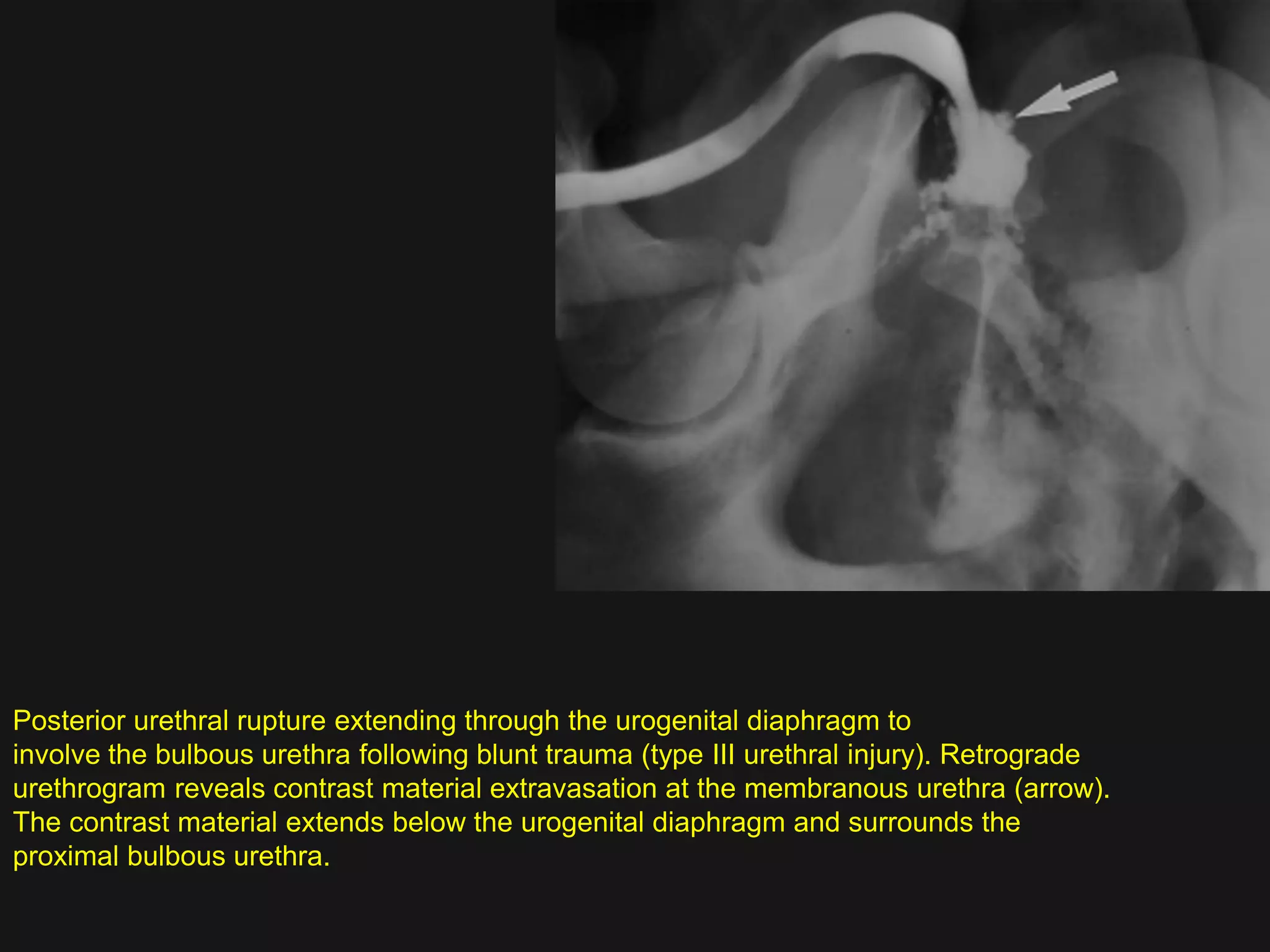 Imaging abdomen trauma urethra trauma part 9 Dr Ahmed Esawy | PPT
